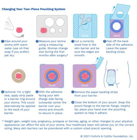 Types of Ostomy Pouching Systems: One-Piece, Two-Piece & Accessories | UOAA