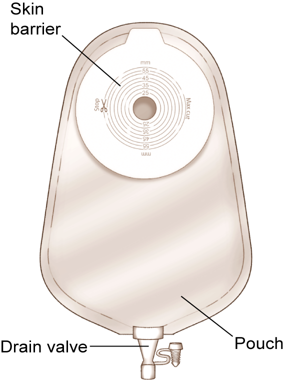 Urostomy Information l United Ostomy Associations of America