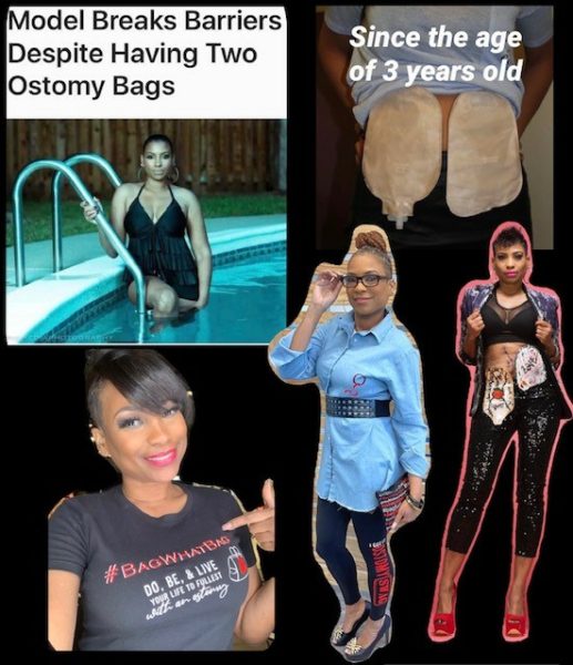 Patient Stories Archives - United Ostomy Associations of America