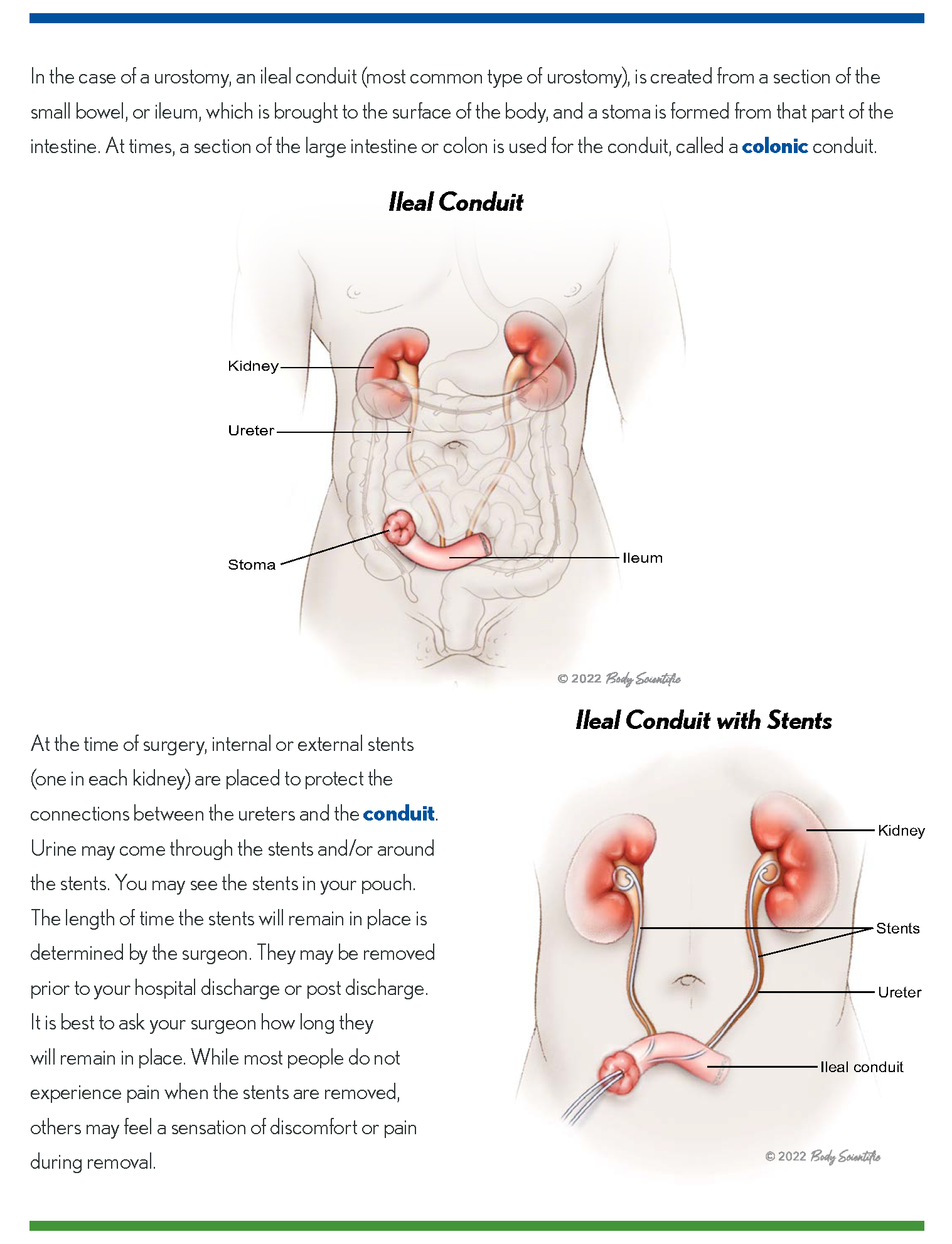 Types Of Urinary Diversion Procedures Ileal Conduit 56 OFF