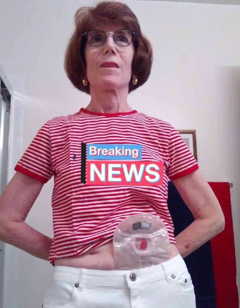 Patient Stories Archives - United Ostomy Associations of America